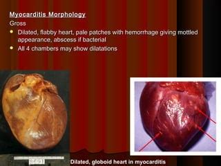 8 Disease Of Myocardium Ppt