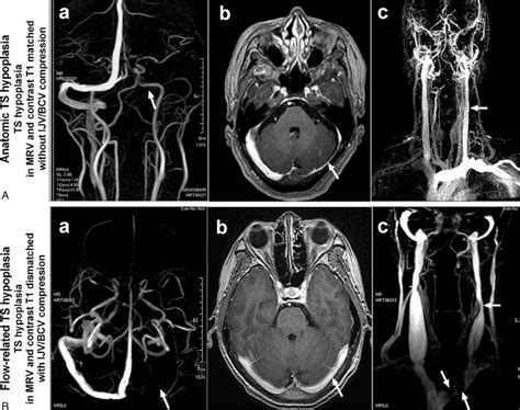 The Concordance And Discrepancy Of Transverse Sinus Ts In Mrv And