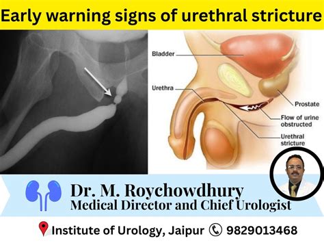 Urethral Stricture Causes Symptoms Diagnosis And Treatment