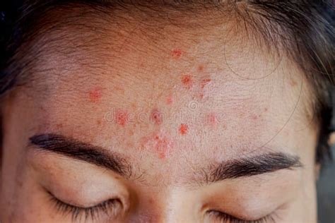 Pimples On Forehead