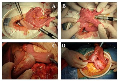 Laparoscopic Assisted Distal Gastrectomy Ab Linear Stapler