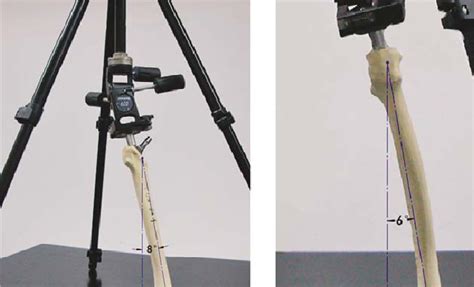 spatial positioning of the femur a position of femur in frontal