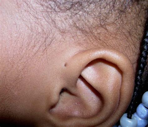 These 5 Celebrities Also Have A Preauricular Sinus Aka Preauricular Pit In Their Ears Kenyalogue