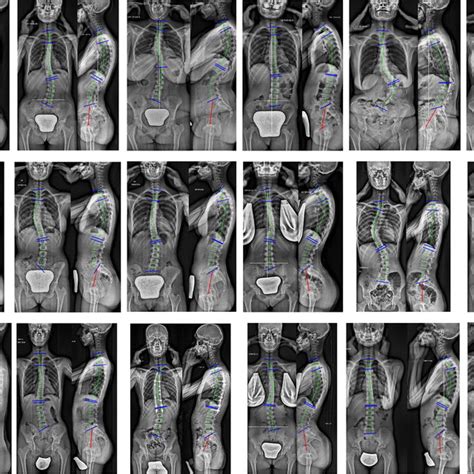 The Four Types Of The Roussouly Sagittal Classification The Shape Of