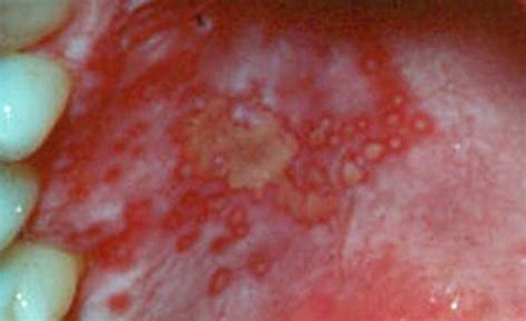 Chlamydia Mouth Sores