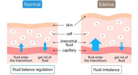Edema Therapy The Rane Center StatDVT Services And Edema Therapy