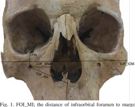 Figure 1 From Correlation Analysis Of Infraorbital Foramen With Related Anatomical Structures