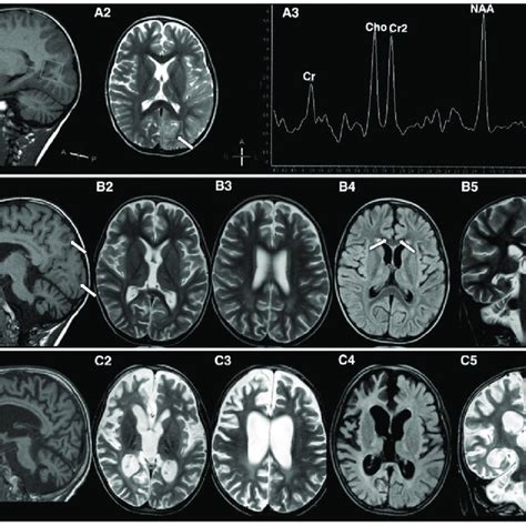 mri brain imaging a mri abnormalities in the acute stage 48 h from