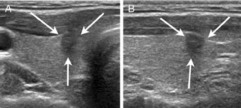 Us Findings Of A Malignant Thyroid Nodule In Underlying Homogenous Download Scientific Diagram