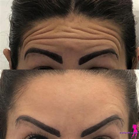 Botox Frontalis How Is It Performed