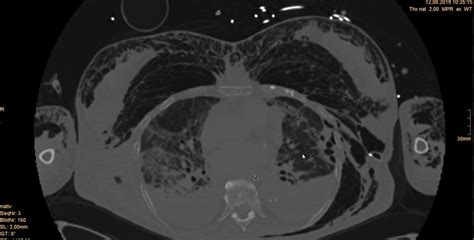 life after ptb r tuberculosis