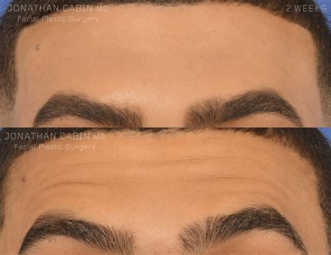 Forehead Botox Cabinmd Facial Plastics And Aesthetics