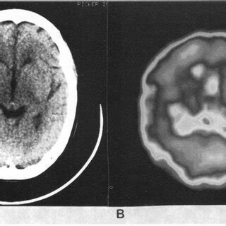 A Brain CT Scan Of Patient 111 8 Showing Mild Cortical Atrophy B Download Scientific