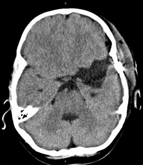 Left Temporal Arachnoid Cyst Doccheck