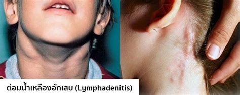 ต่อมน้ำเหลืองอักเสบ อาการ สาเหตุ และวิธีรักษาต่อมน้ำเหลืองอักเสบ 3 วิธี