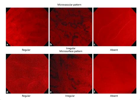 Microvascular And Ms Classification Vs Classification Based On