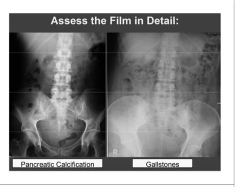 Cholelithiasis X Ray