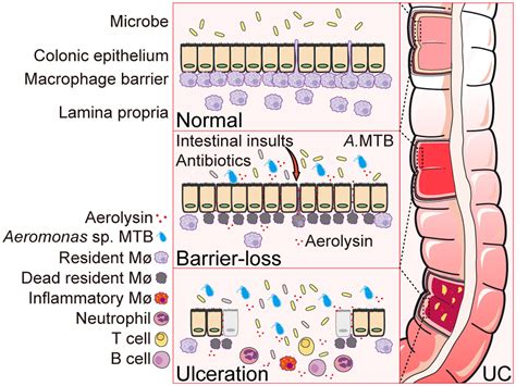 This Bacterial Toxin Could Be The Hidden Cause Of Ulcerative Colitis