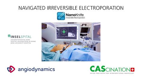 Stereotactic Navigation For Percutaneous Ire Youtube