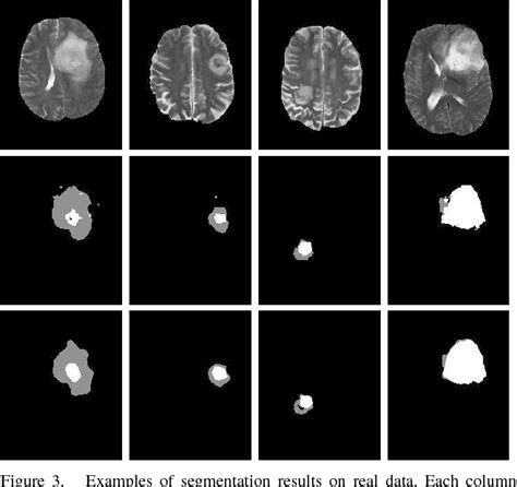 Figure 3 From Automatic Brain Tumor Segmentation From Mr Images Via A Multimodal Sparse Coding