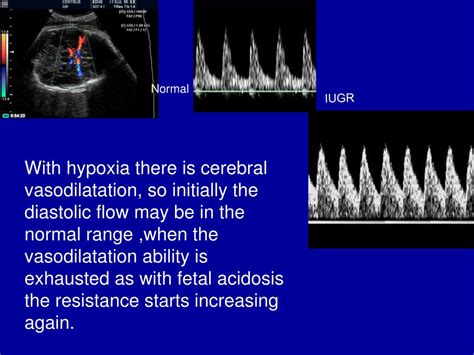 Ppt Middle Cerebral Artery Doppler Powerpoint Presentation Free Download Id 6598483