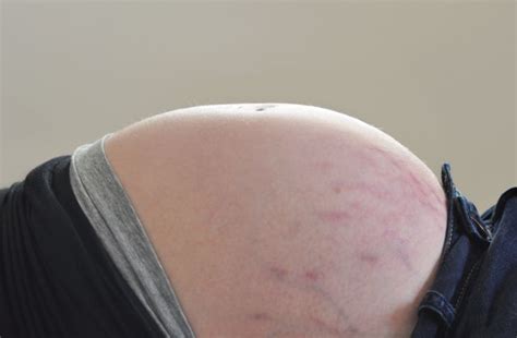 How To Prevent Stretch Marks During Pregnancy