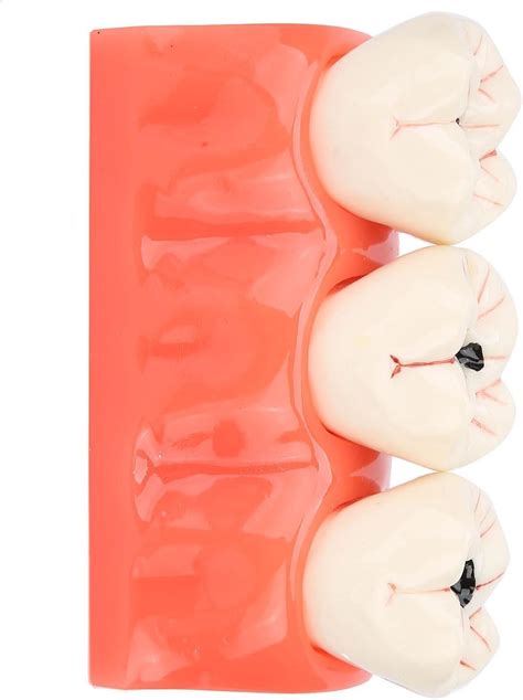 Verdant Touch Simulation Teeth Caries Model Removable Tooth Caries