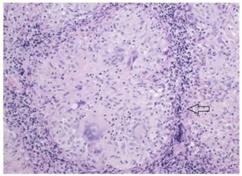 Lung Mass With Bilateral Mediastinal Hypermetabolic Lymphadenopathy In