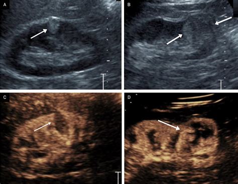 Renal Angiomyolipoma Usg