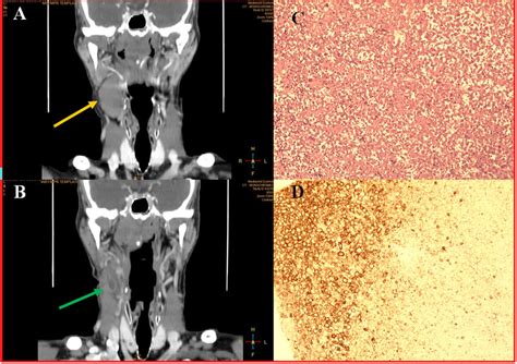 Idiopathic Lymph Node Infarction In A 70 Year Old Man A Neck Ct