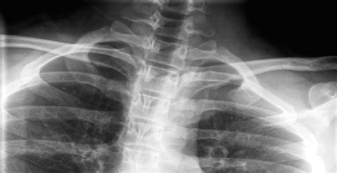 Posterior Sternoclavicular Dislocation Journal Of Emergency Medicine