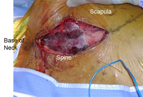 Thoracotomy For Exposure Of The Spine Ctsnet