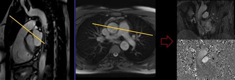 Cardiac Mri Flow Quantification Protocols Planning And Techniques