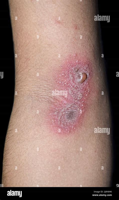 Paederus Dermatitis In Arm It Is A Peculiar Irritant Contact One Caused By A Beetle Belonging