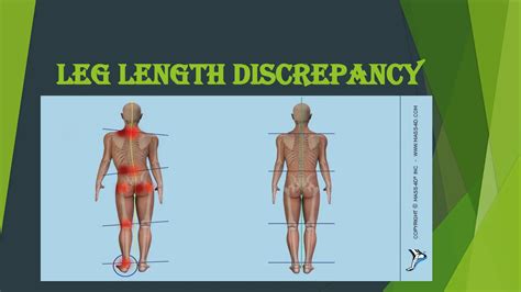 Leg Length Discrepancy Asessment And Management Pptx