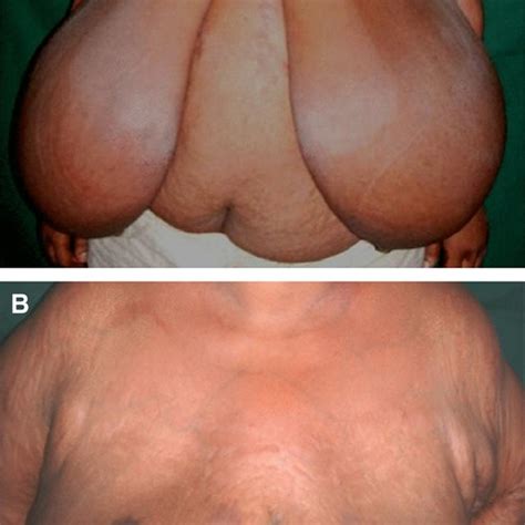 A 45 Year Old Breast Hypertrophy Patient A Preoperative View B After