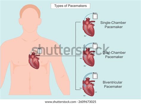 Different Types Pacemakerssingle Chamber Dual Chamber Biventricular Stock Vector Royalty Free