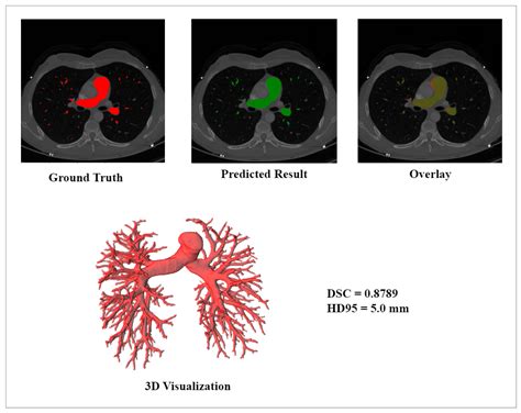 Dru Net Pulmonary Artery Segmentation Via Dense Residual U Network