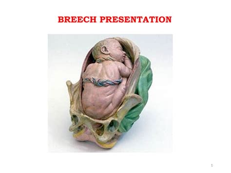 Breech Presentation 12pptxggggbcxxxcccc Pptx