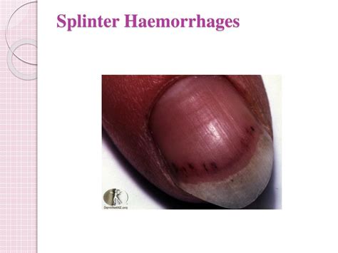 Ppt Infective Endocarditis Powerpoint Presentation Free Download