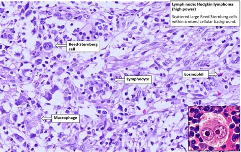Lung And Lymph Nodes Hodgkin Lymphoma Nus Pathweb Nus Pathweb