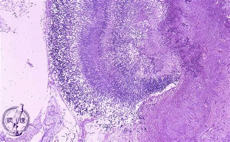 5lung Pleura 9 Fungal Pneumonia Aspergillosispathology Core Pictures