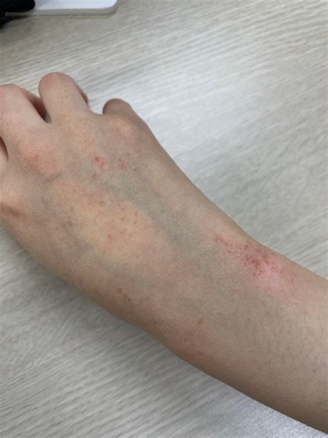 손 틈 손 갈라짐 피부과 가야할까요 지식in