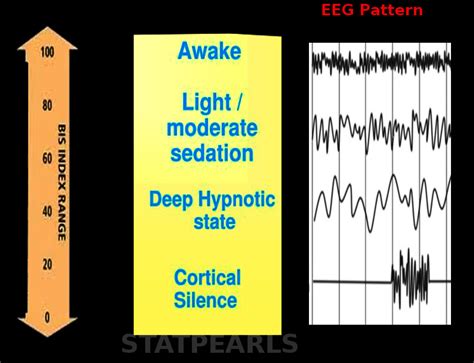 [figure Bispectral Index Image Courtesy S Bhimji Md] Statpearls Ncbi Bookshelf