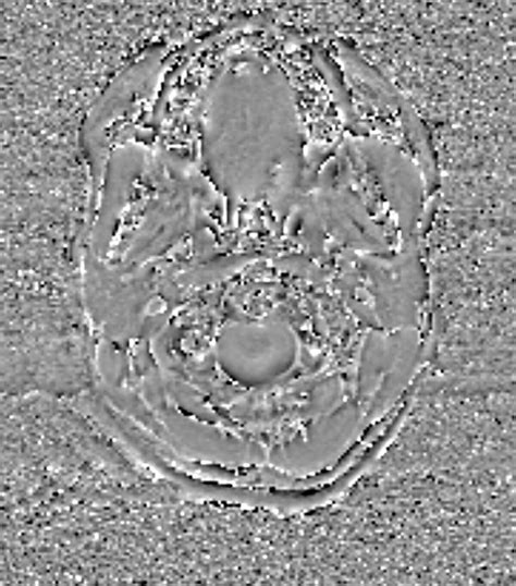Choroid Plexus Carcinoma Radiopaedia 91013 108553 Axial Swi Phase Nc Commons