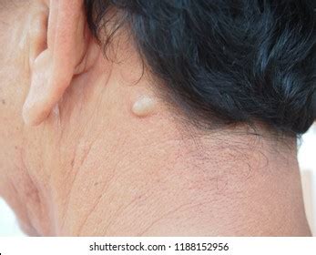 Epidermoid Cysts Neck