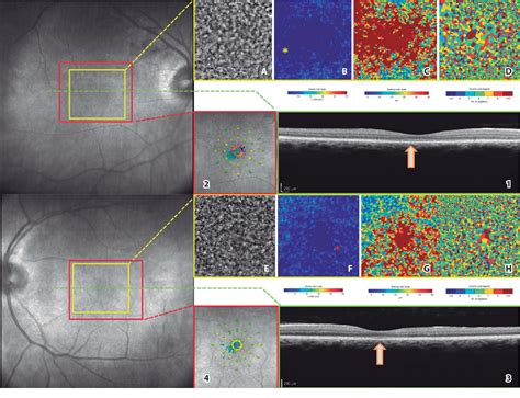 Figure 2 From Structure Functional Correlation Using Adaptive Optics Oct And Microperimetry In