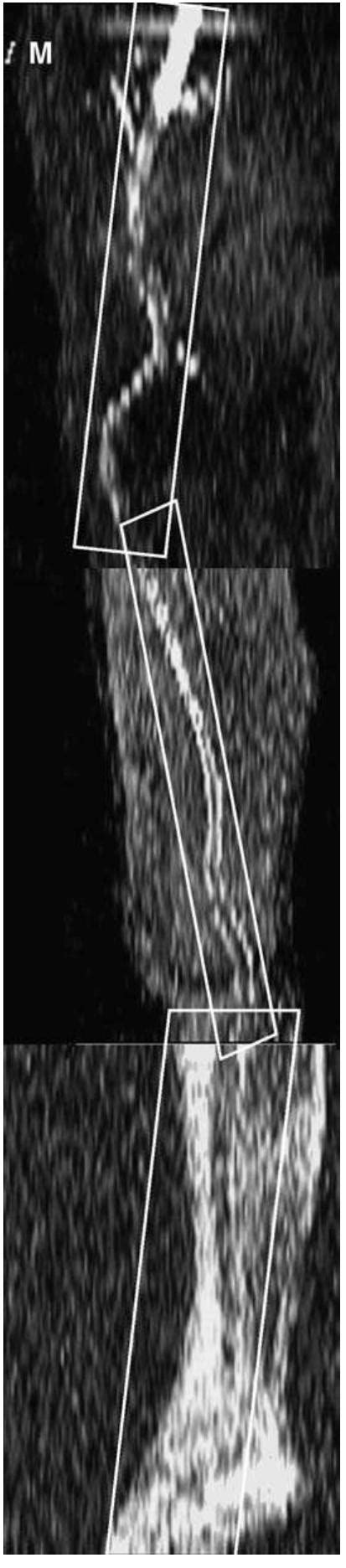 The Technique Of 2d Contrast Enhanced Mr Angiography Is