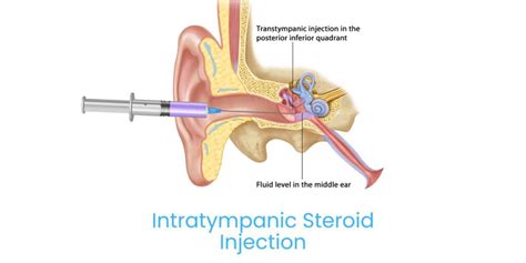 Intratympanic Steroid Injection In Bhubaneswar