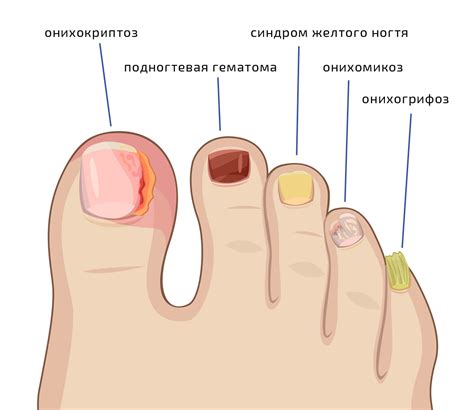 Лечение грибка ногтей в домашних условиях - Exotic Nails